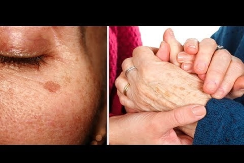 Manchas Marrones En La Piel: Causas, Prevención Y Tratamiento – EFDYEQ
